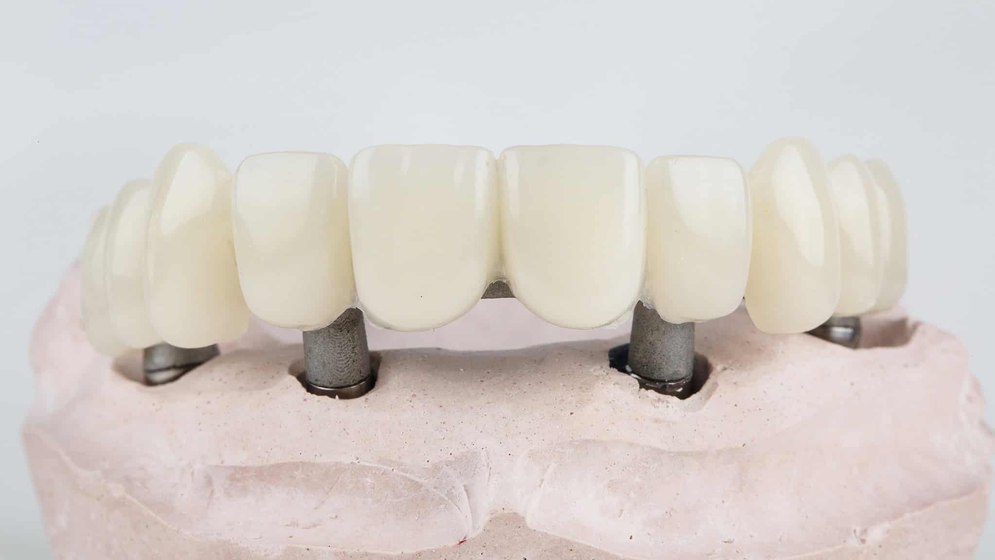 What Are All-On-4 Implants? A Quick Guide to Full Arch Restoration ...