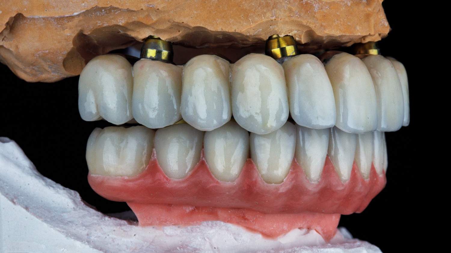 What Are All-On-4 Implants? A Quick Guide to Full Arch Restoration ...